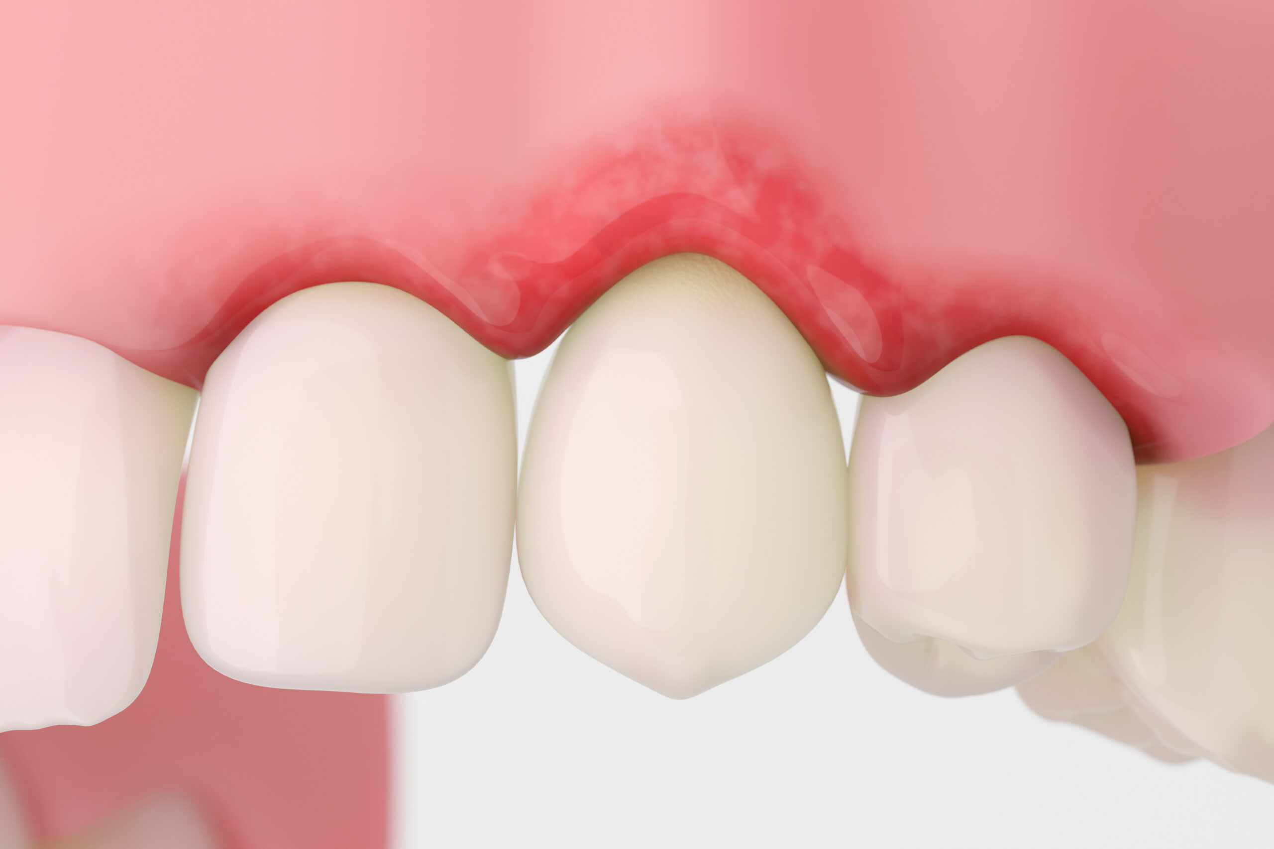 Preventing Gum Disease At The First Sign Of Trouble | Brooklyn, NY