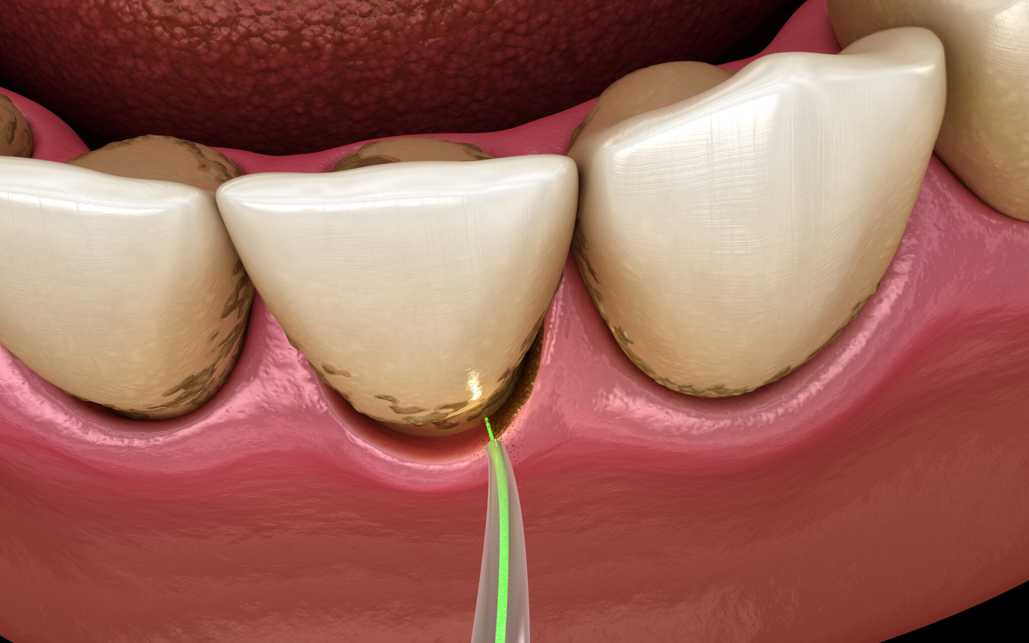 How Dental Lasers Manage Your Gum Disease | Brooklyn, NY