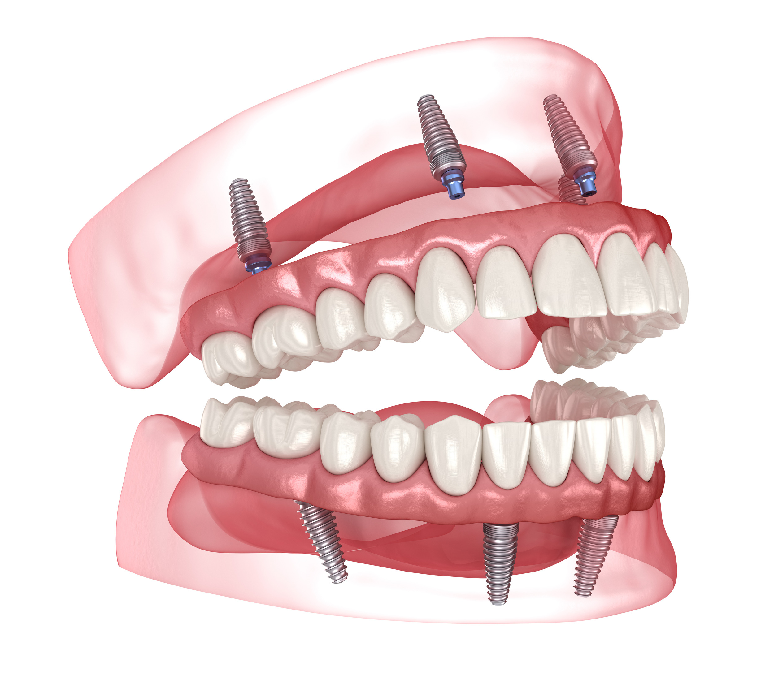 An Implant Solution For Severe Tooth Loss | Brooklyn, NY